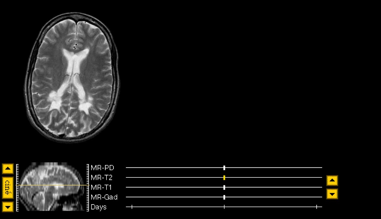 Multiple Sclerosis | Brain Interactive