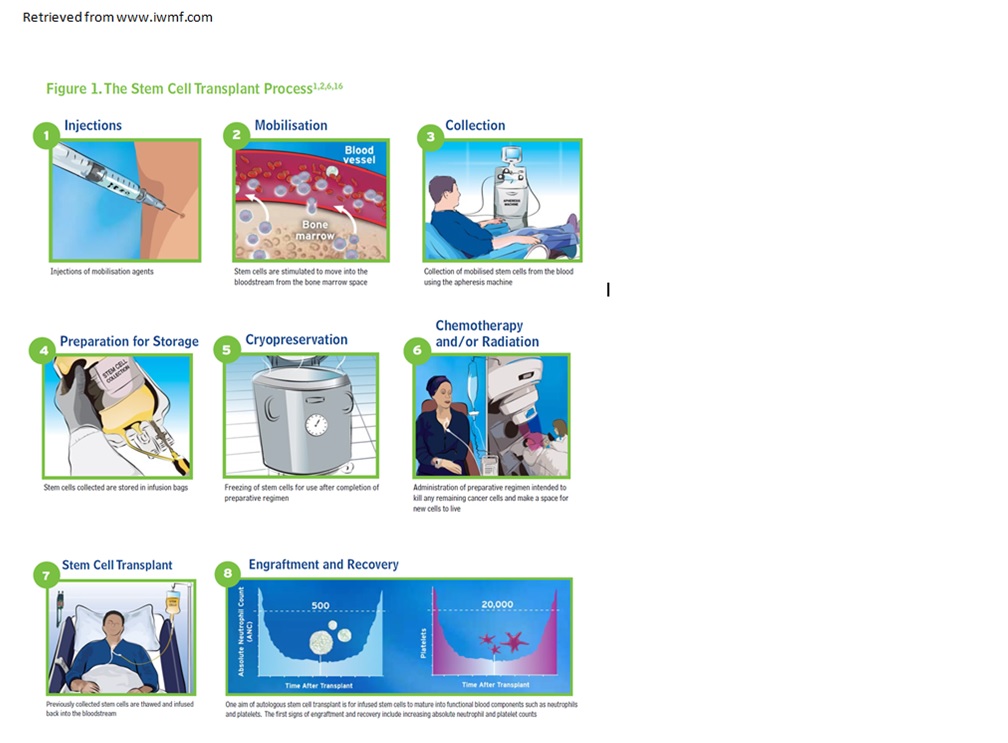 A Fierce Fight against CIDP: The treatment (HSCT)