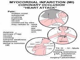 Myocardial+Infarction+Treatment.jpg