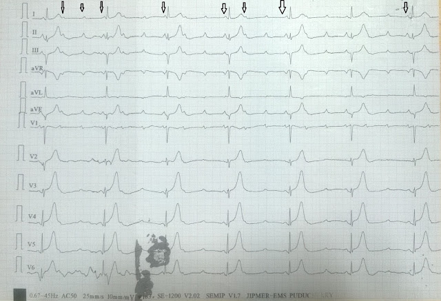 Cardiology window: Complete heart block