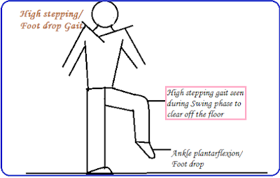 FOOT DROP / HIGH STEPPING GAIT Physiotherapy Mx - PHYSIO STUDY
