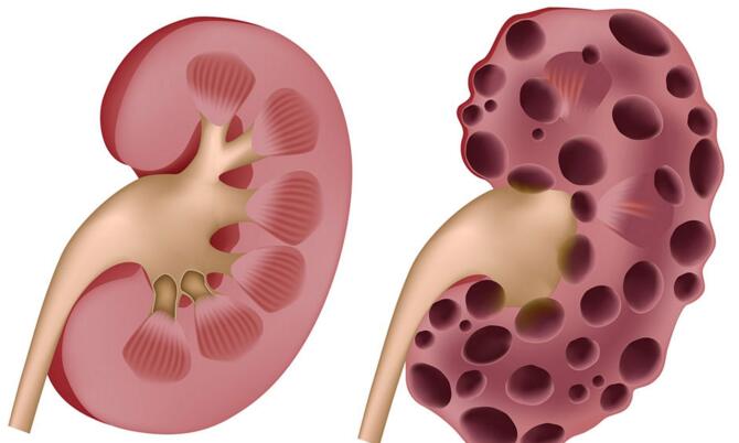 traitement de l'insuffisance rénale: Quels sont les signes avant ...