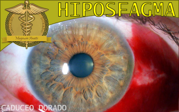 Caduceo Dorado: HIPOSFAGMA (SANGRADO, HEMORRAGIA SUBCONJUNTIVAL)