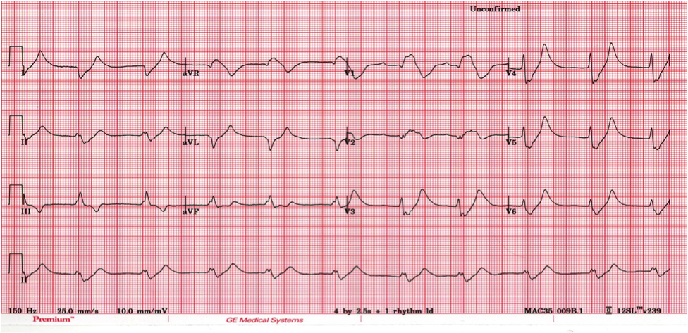 Hey Doc: The sine wave EKG