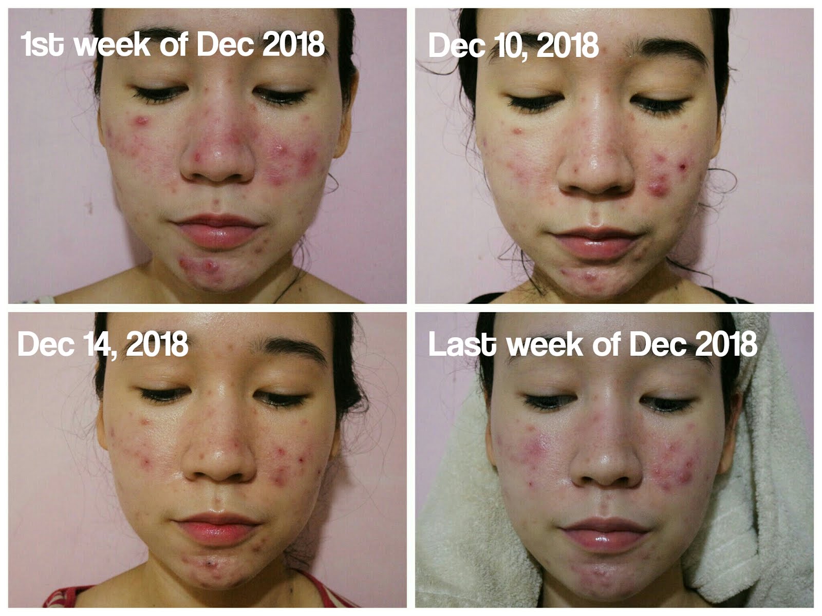 My ISOTRETINOIN JOURNEY (ACNOTIN/ACCUTANE) 6 MONTHS SKIN UPDATE ...