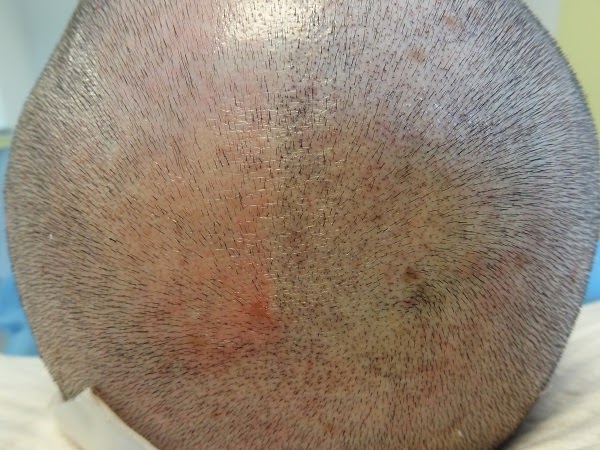 More interesting stuff about Scalp Micro Pigmentation