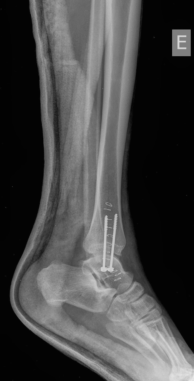 Fractura Pilao tibial e maleolo lateral dto + Fractura maleolo medial ...