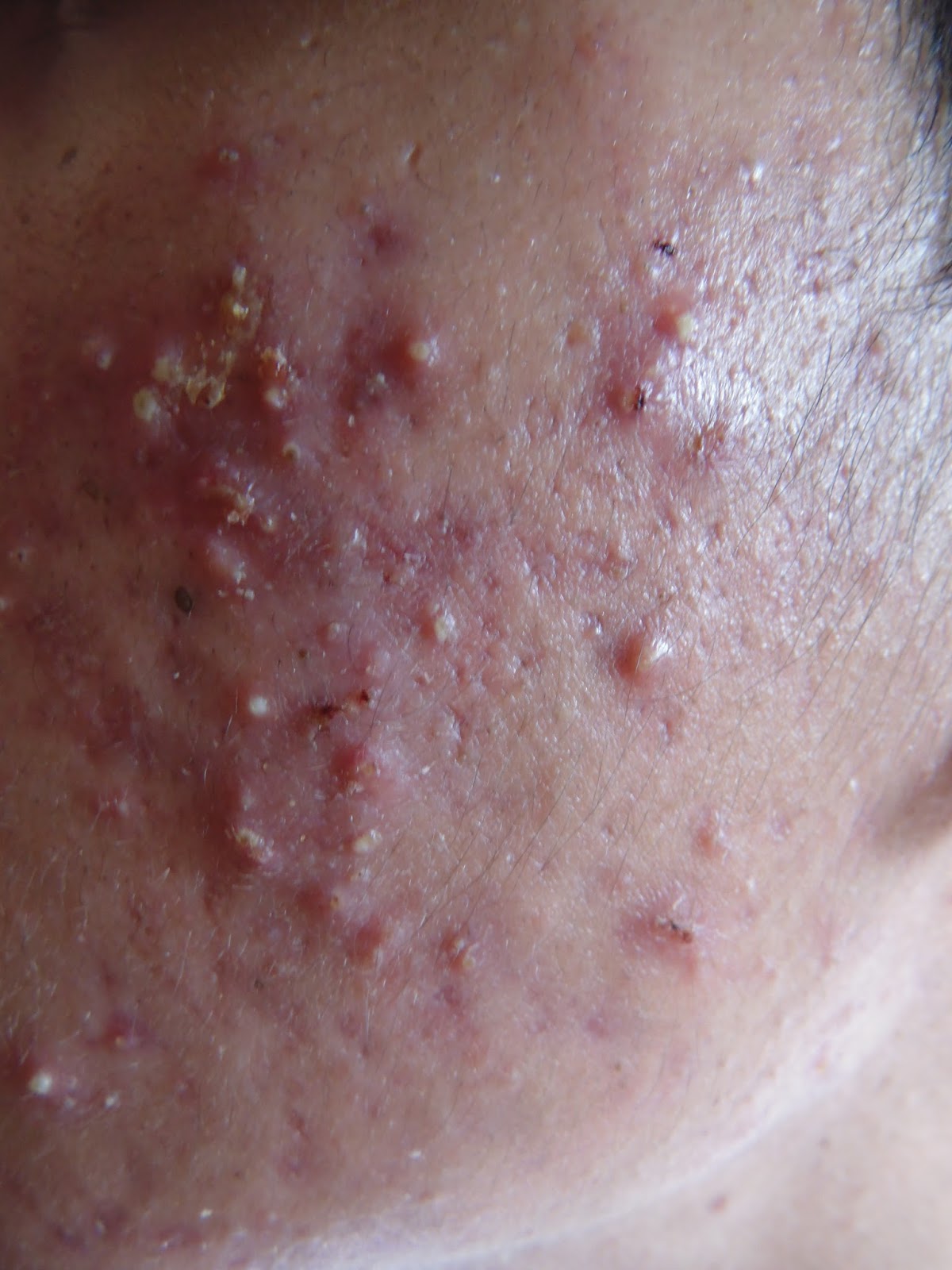 Retorno ao Dermatologista e Inicio do Tratamento com Roacutan ...