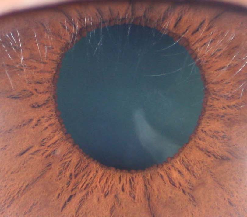 Modern & Multidimensional Iridology: IPB Morphologies, Space Risk ...