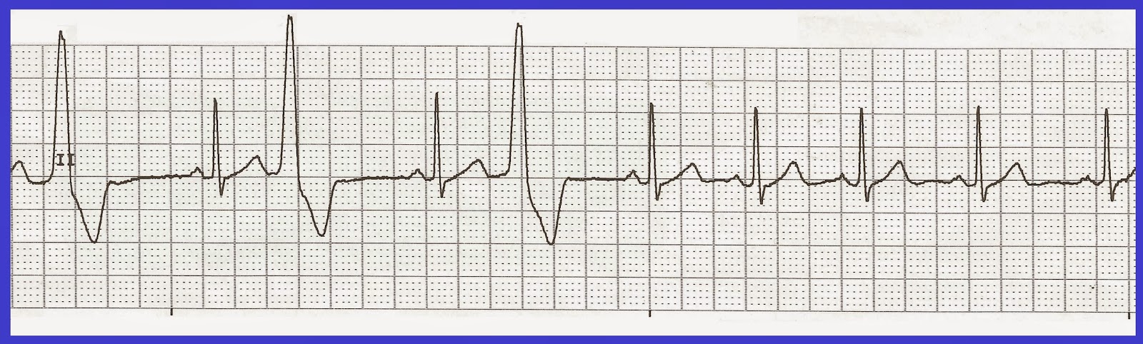 Practice EKG Rhythm Strips 210