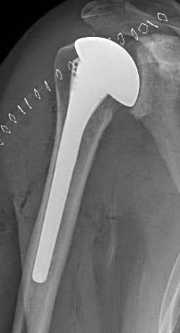 UW Shoulder and Elbow Academy: The humeral component - importance of ...