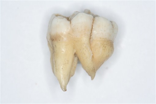 Deformutilation: Concrescence - Tooth Fusion