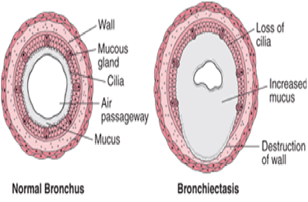 Chest Medicine Made Easy-Dr Deepu: The Rings !!!The Trams!!!, Chest X ...