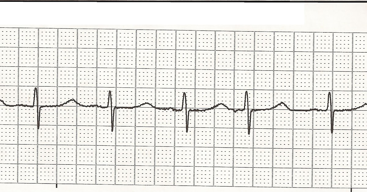 EKG Rhythm Strips 32