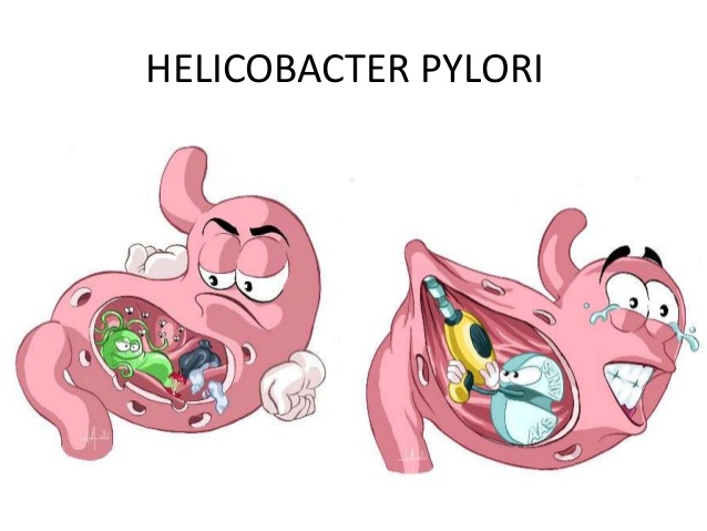 Infectia cu Helicobacter pylori si terapiile naturale | Dr. Ruxandra ...