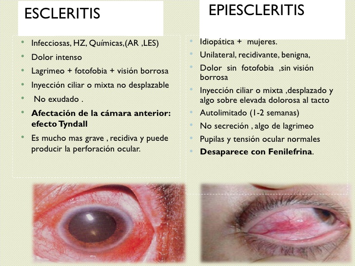 Clínicaibm.com: Diferencia entre la Episcleritis y la Escleritis