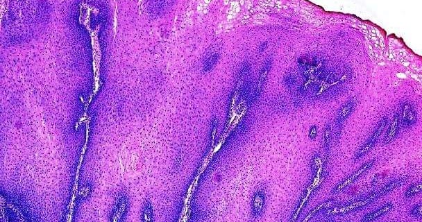 Verrucous squamous cell carcinoma