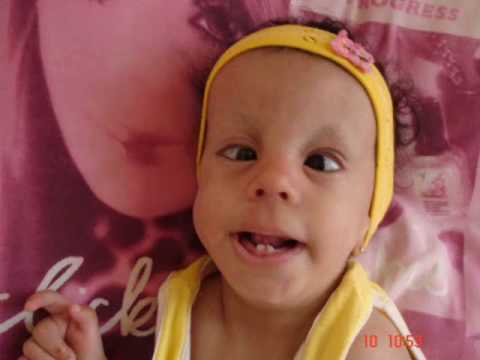 egolegal: A síndrome de Edwards (ou trissomia 18)