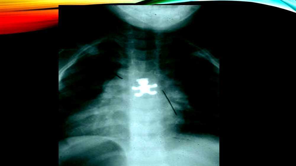 Foreign body in alimentary tract