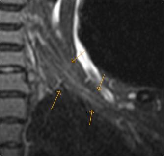 Two Cases of Plexitis in a Day-MRI - Sumer's Radiology Blog