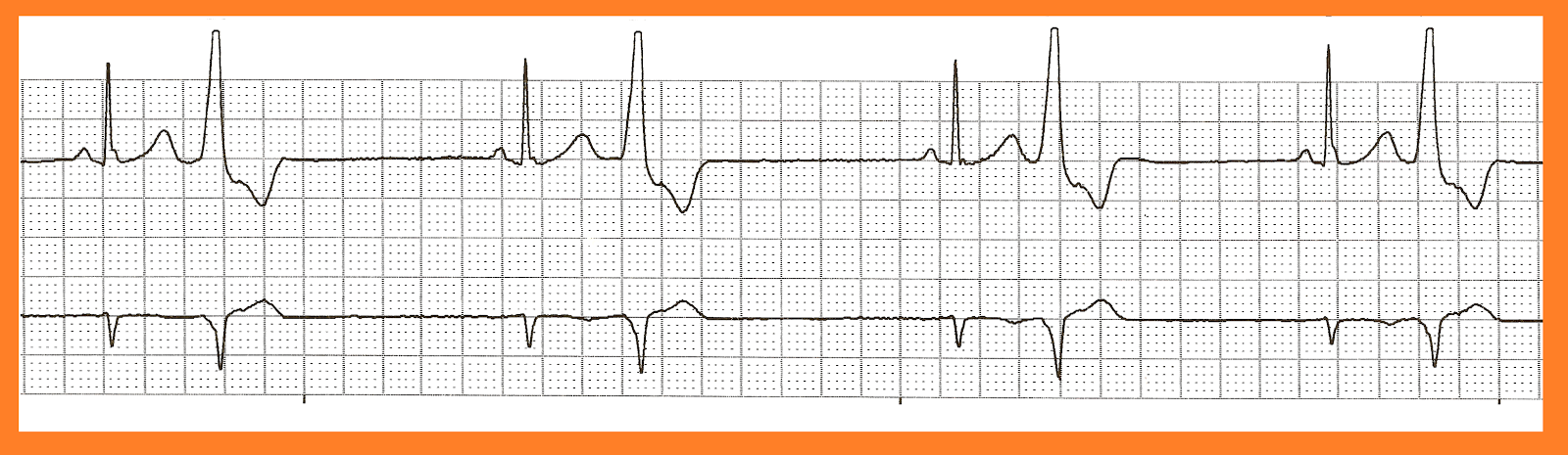 EKG Rhythm Quiz 274