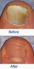 Medical Treatment Pictures-for Better Understanding: Nail Removal ...