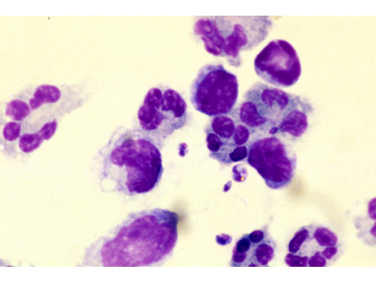 Medical Stuff: Cryptococcosis