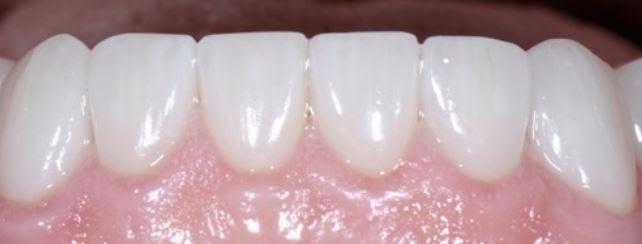 How to avoid fracture/chip in all ceramic crowns