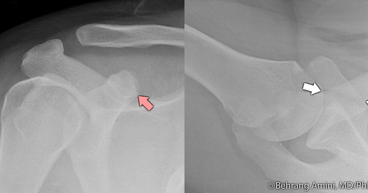 Roentgen Ray Reader: Coracoid Fractures