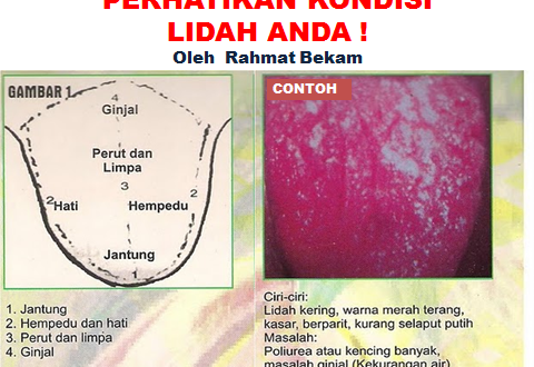 Begini Cara Membaca Sakit Anda Lewat Lidah,! Tolong Sebarkan Artikel ...