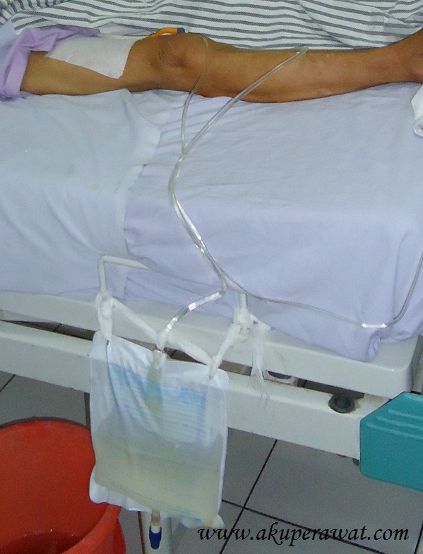 Meminimalkan Perdarahan dengan Pemasangan Traksi Kateter Pada Pasien ...