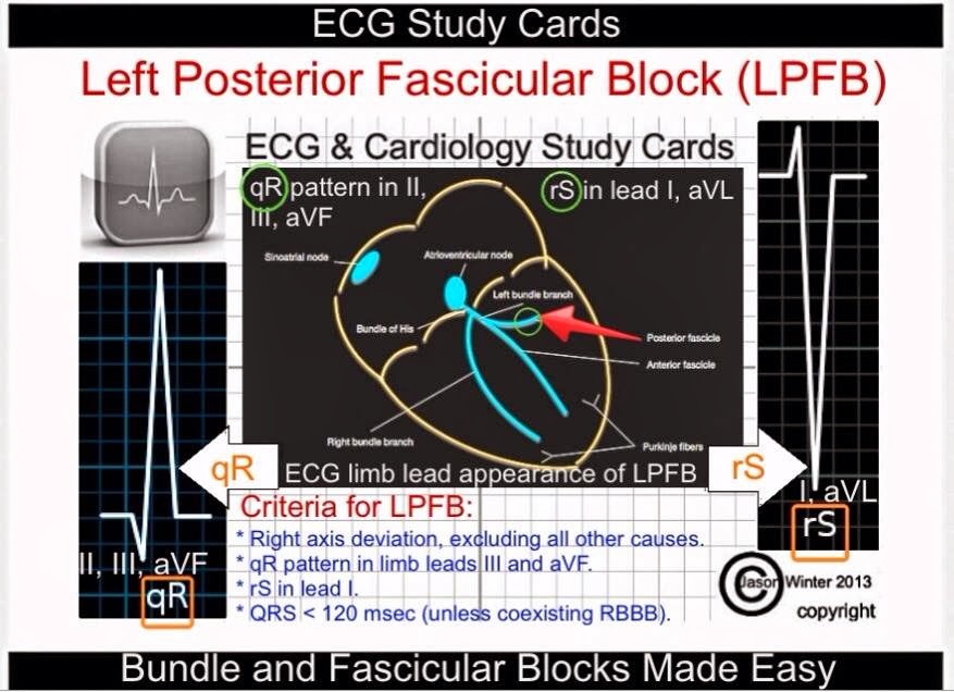 ECG Lessons Online: January 2014