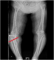 Joint Preservation and Replacement : Osteoarthritis knee- post trauma ...