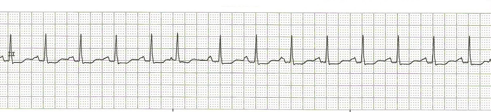ECG Rhythm Strip Quiz 63