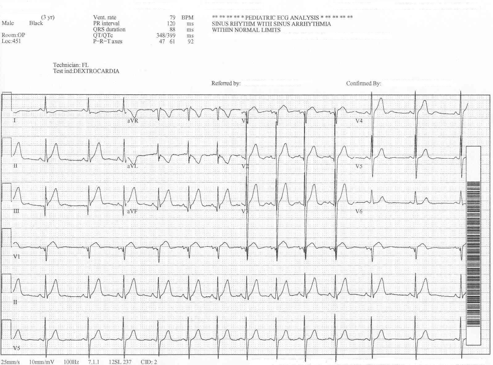 Pedi cardiology: EKG: Dextrocardia