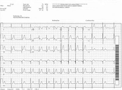Pedi cardiology: EKG: Dextrocardia