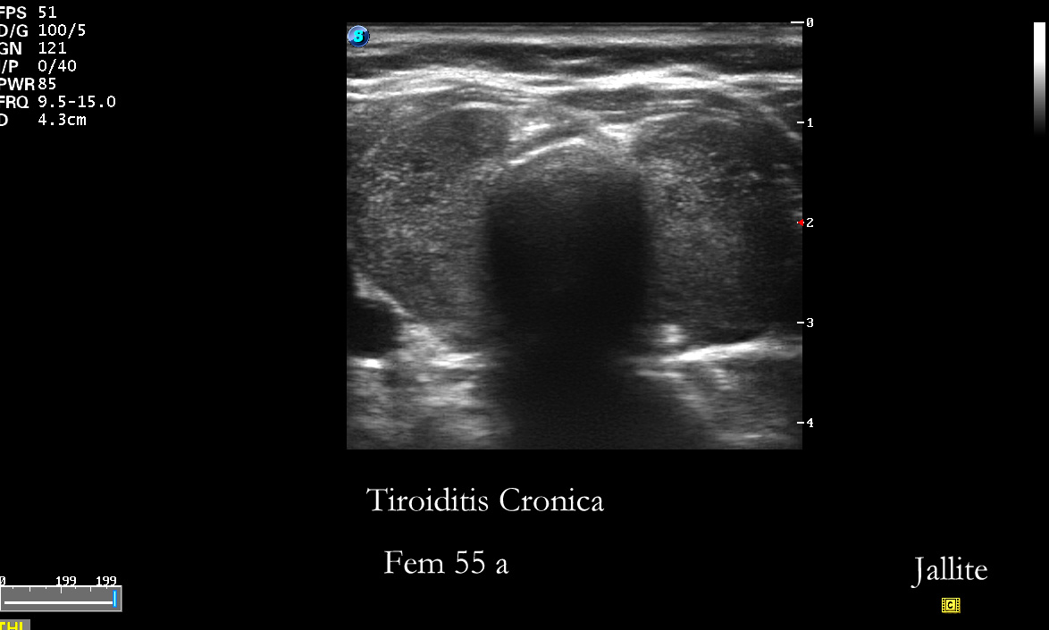 Tiroiditis Crónica