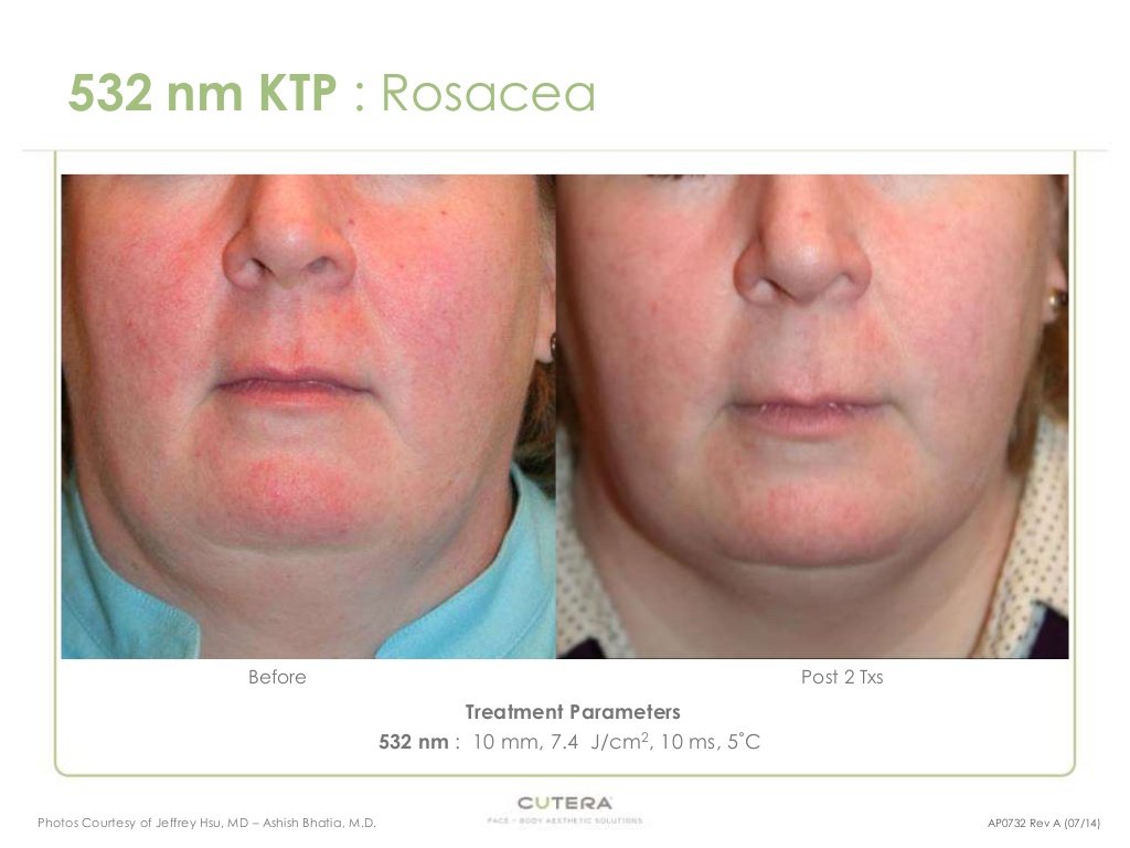 W클리닉 장웅철 원장 (www.wclinics.co.kr): 엑셀V 레이저 - 홍조, 혈관, 색소 개선의 베테랑 레이저