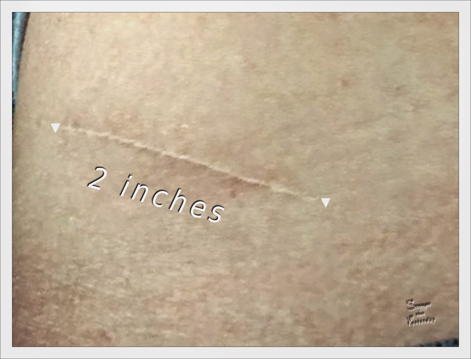 Stronger than Yesterday: Grafts of a Girl