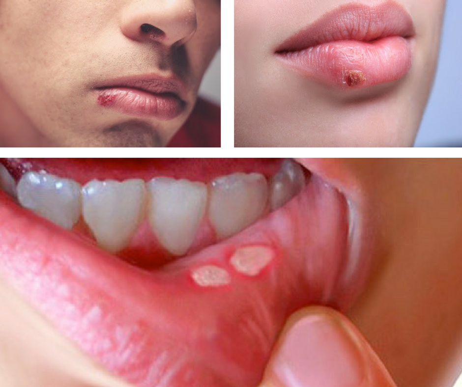 Dieta sem Glúten: Aftas, feridas nos lábios e Doença Celíaca