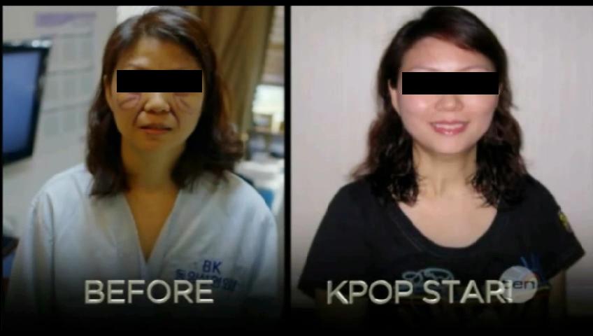 Eyelid Surgery Legend Dr. Kim Byung Gun: [BK Plastic Surgery Hospital] Featured in a Broadcast ...