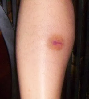 Thelma Regina Siqueira Linhares: FURÚNCULO