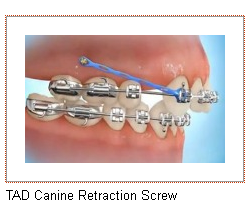 Robison Orthodontics Mesa Arizona : Gilbert AZ Orthodontic Braces TAD ...