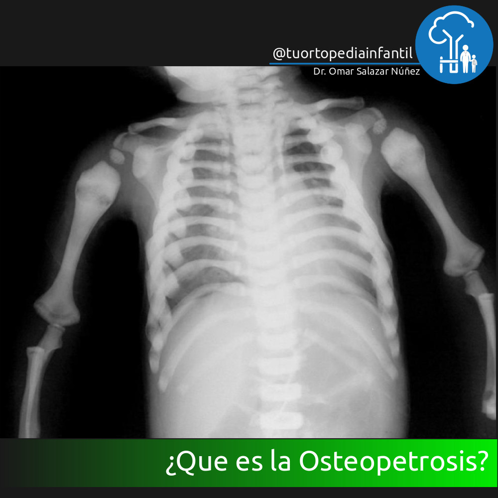 ¿Que es la Osteopetrosis?