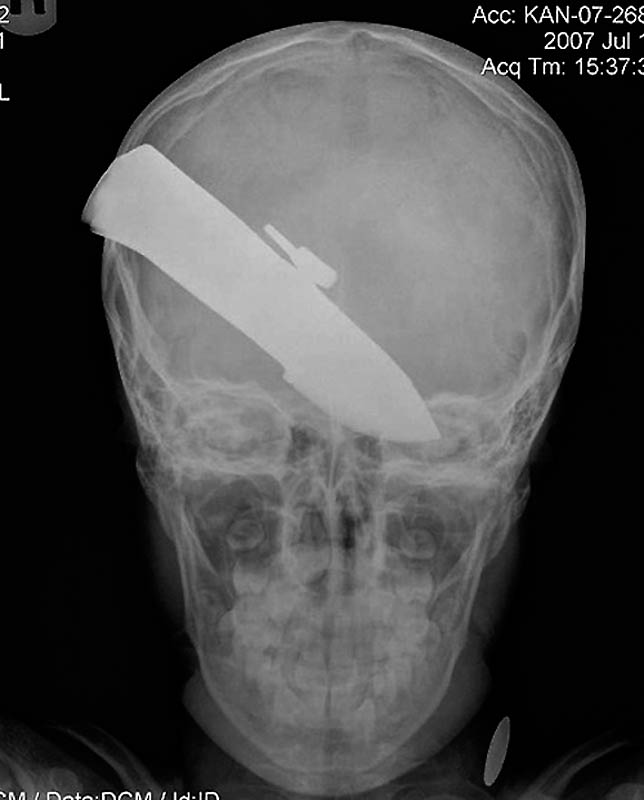 Deformutilation: Disturbing X-Rays