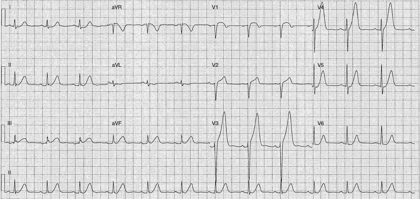 ECG of the Week: ECG of the Week - 6th October 2014