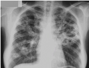 Spirometry -Spirogram-Pulmonary volumes and capacities-factors