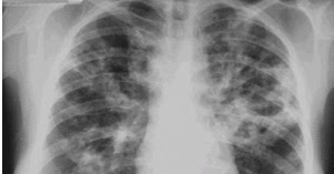 Spirometry -Spirogram-Pulmonary volumes and capacities-factors