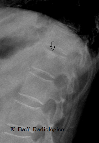 El Baúl Radiológico: ENOSTOSIS: ISLOTE ÓSEO (Bone Island: CT and MRI ...