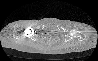 ABC Radiology Blog: Computed Tomography Artifacts